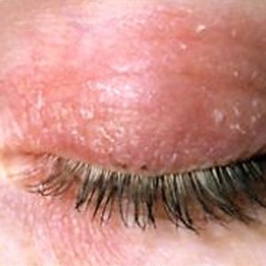 Blepharitis & Meibomitis | Best Lid Hygiene Practices