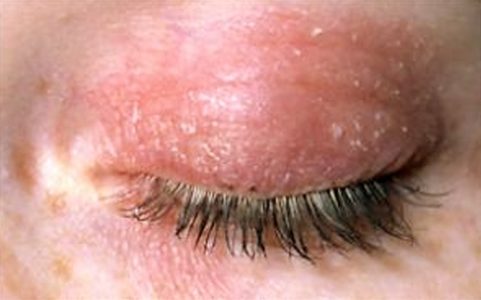 Blepharitis&Meibomitis aka Dirty Eyelids | Optometry Blog – Wink Optometry